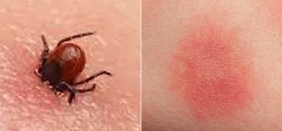 70enne perde la vita dopo il morso di una zecca